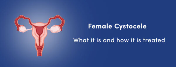 Female Cystocele: What it is and how it is treated - Urogyn